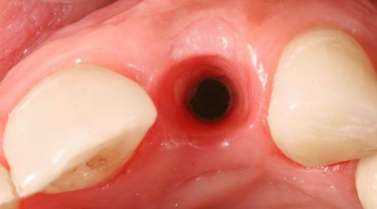Socket Preservation - Cary Prosthodontics & Cosmetic Dentistry in Cary, NC